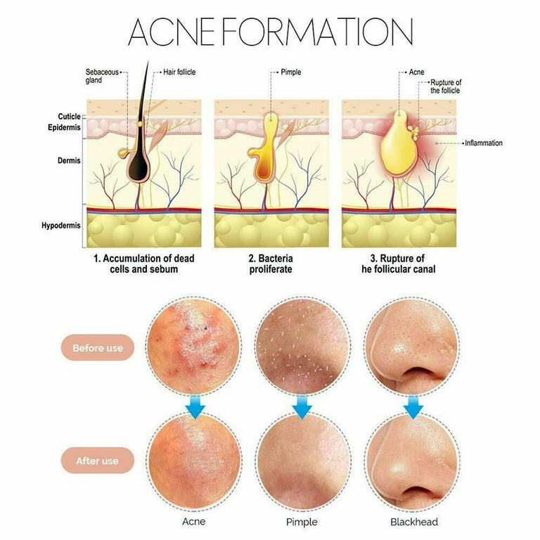Popped Pimple Diagram
