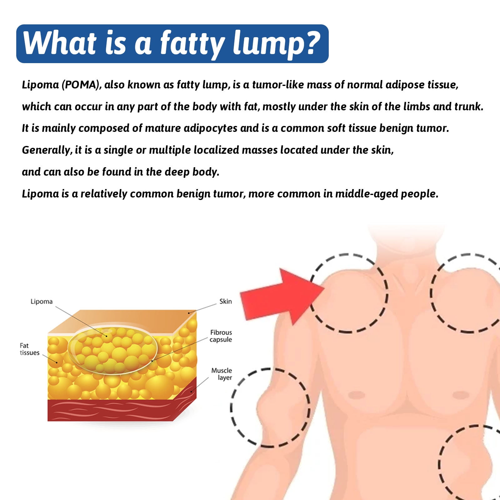 Fatty Lumps In Abdomen