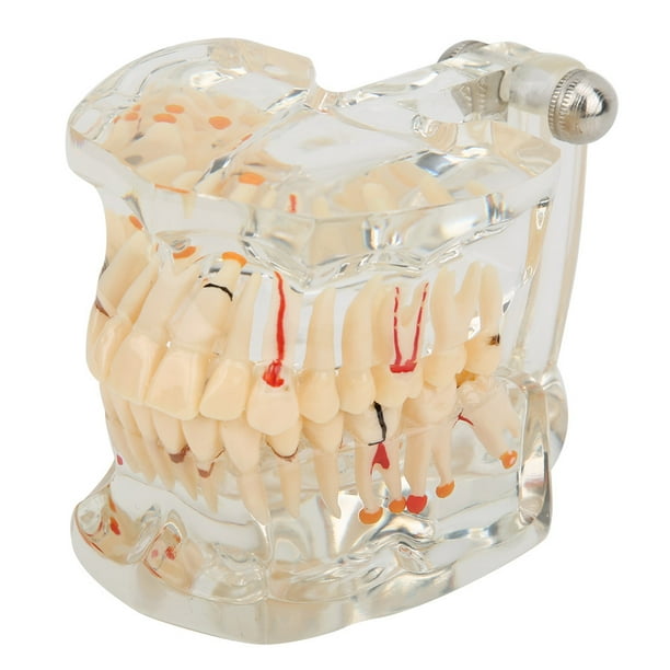 Teeth Models,Transparent Disease Teeth Model Dental Teeth Models Dental ...