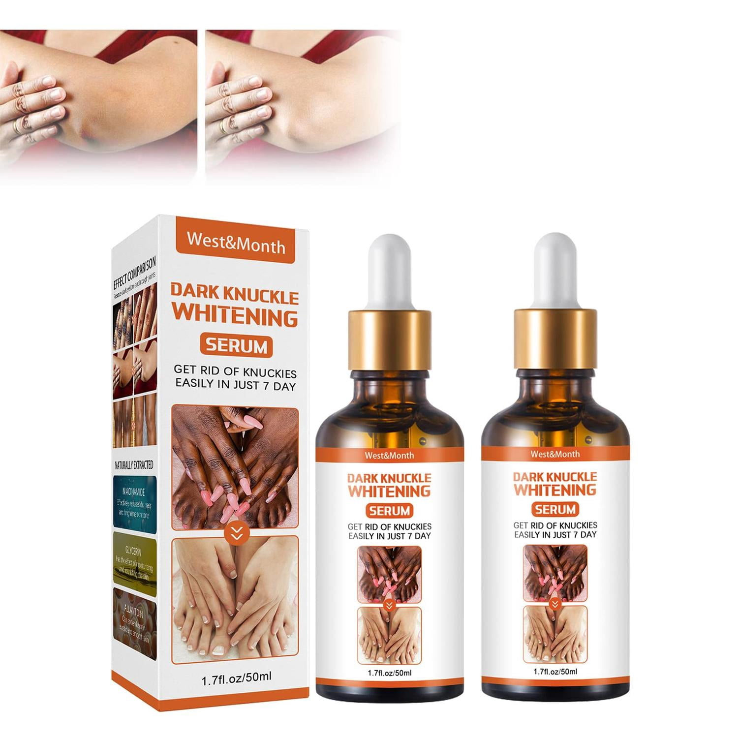 Tratamiento corporal para Acantosis Nigricans y manchas oscuras con ...