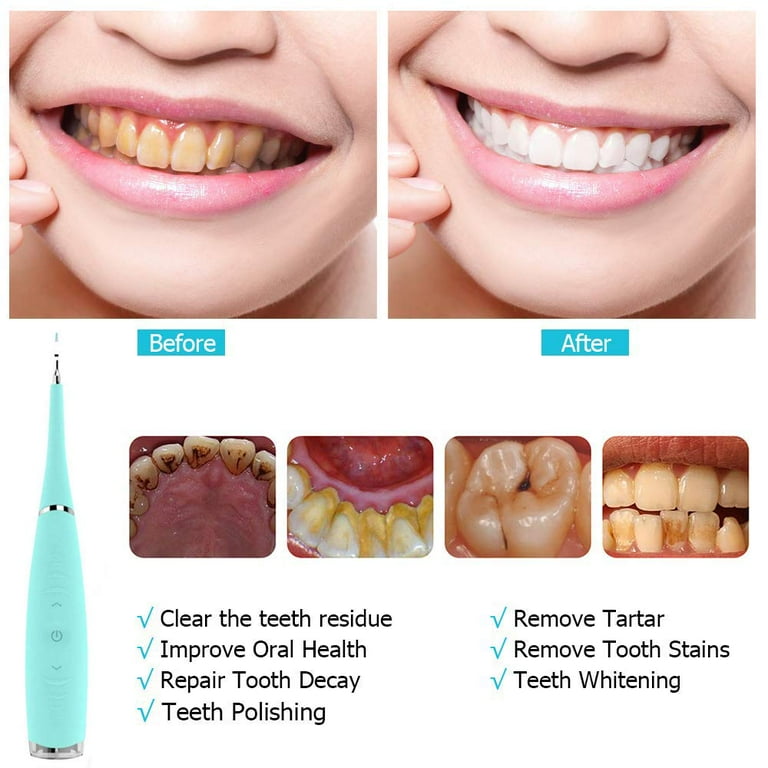Dental Calculus Before And After