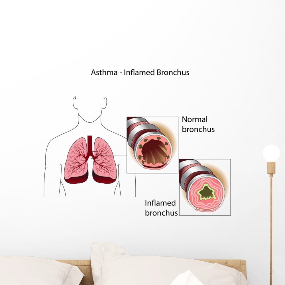 Asthma Wall Decal Mural by Wallmonkeys Vinyl Peel and Stick Graphic for ...