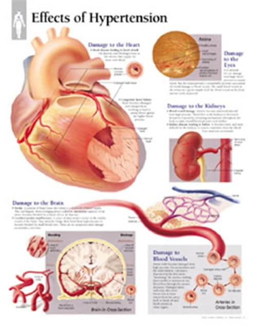 Pre-Owned Effects of Hypertension chart : Laminated Wall Chart ...