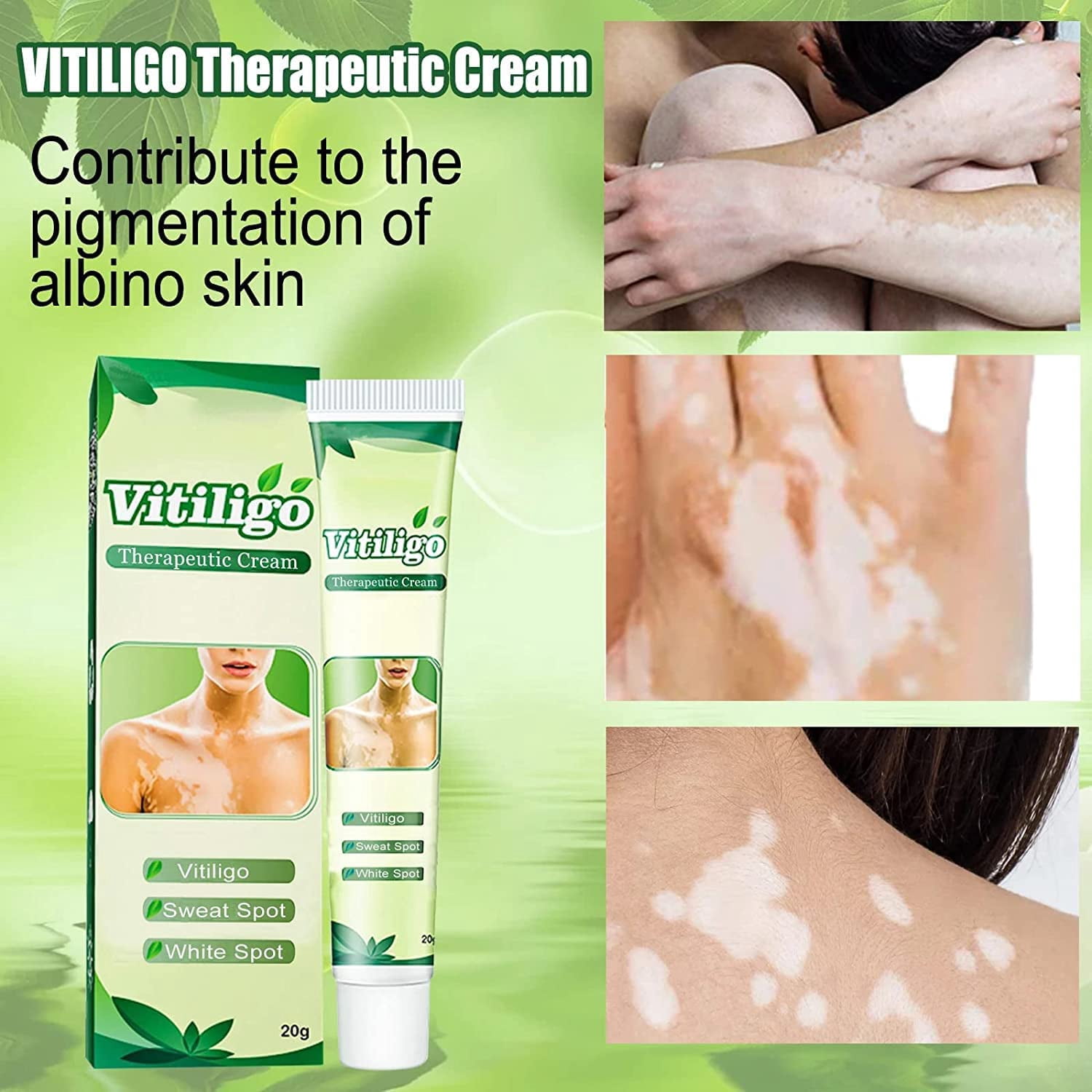 Buy 1pcs White Tag Treatment Moisturizing Cream Vitiligo Treatment Buy 1pcs White Tag Treatment Moisturizing Cream Vitiligo Treatment