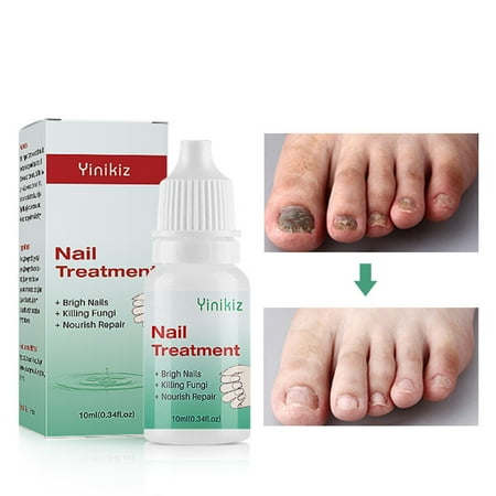 Fragile, Streaky, Split Nails | Nail Serum Treats & Repairs ...