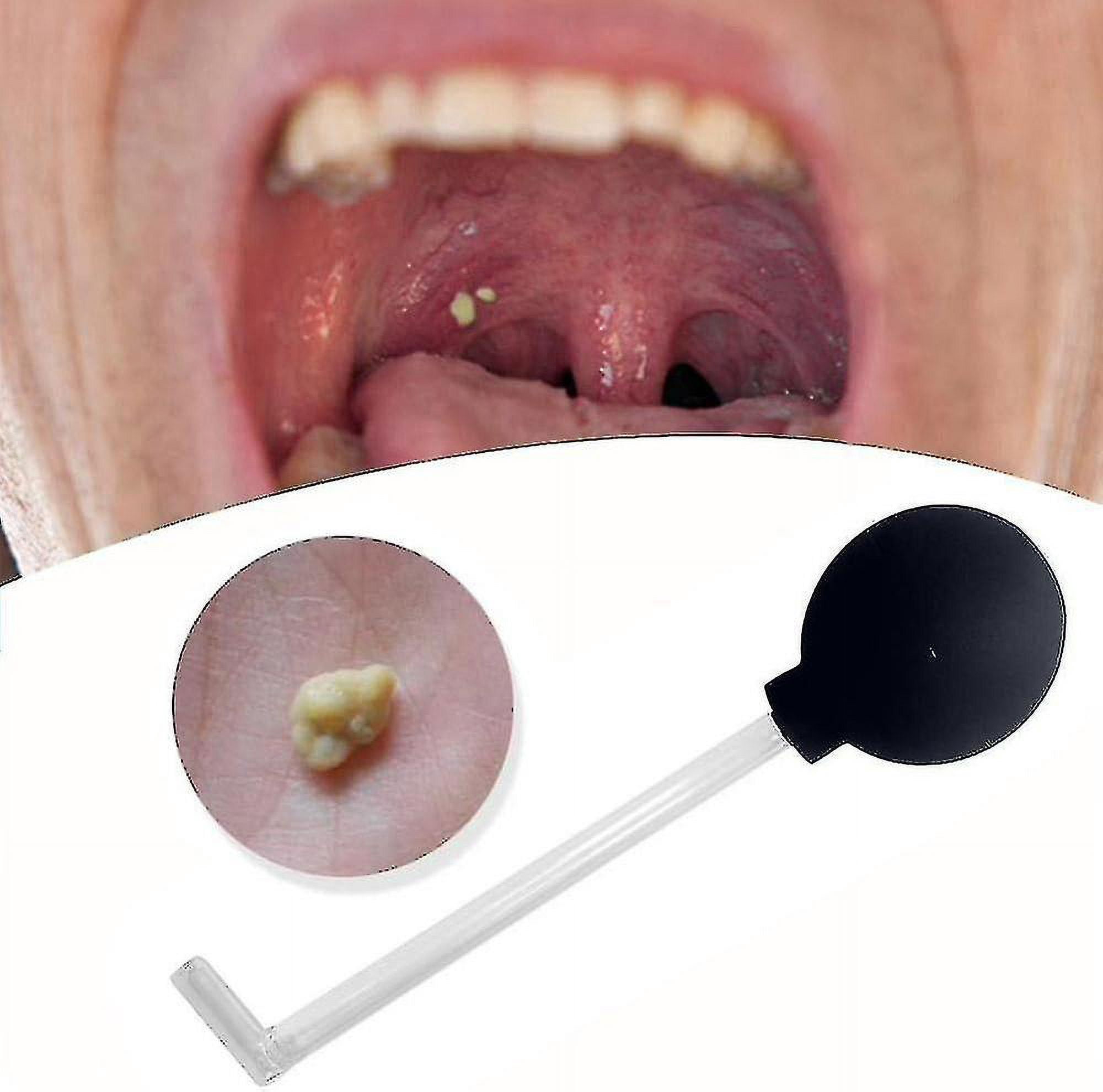 Tonsil Stone Remover Vacuum, Tonsil Stone Removal Kit Tool Tonsil Stone ...