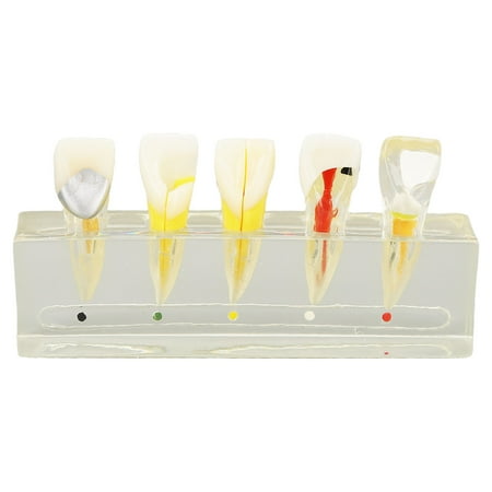 Dental Pulp Model,Dental Pulp Cavity Model Dental Endodontic Model ...