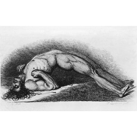 Tetanus (Lockjaw) Victim. The Contracted Body Of Soldier Suffering From ...