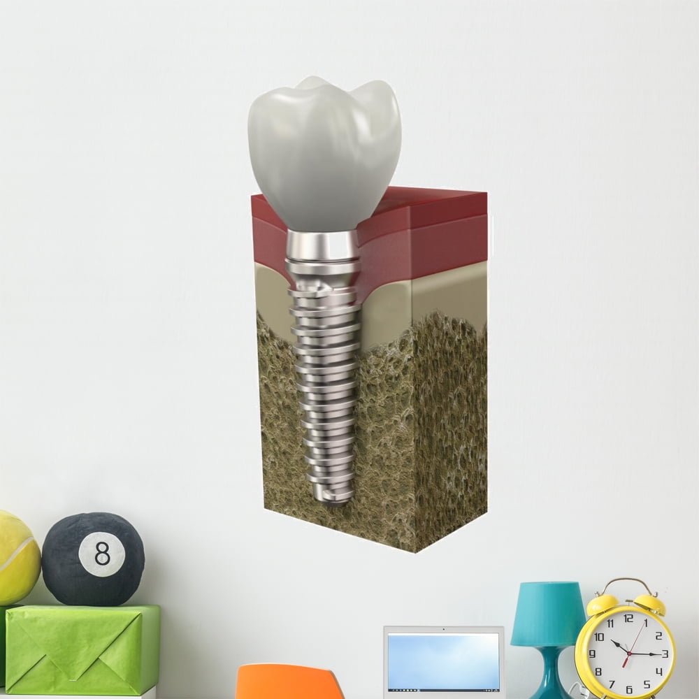 Dental Implant Wall Decal by Wallmonkeys Peel and Stick Graphic (48 in ...