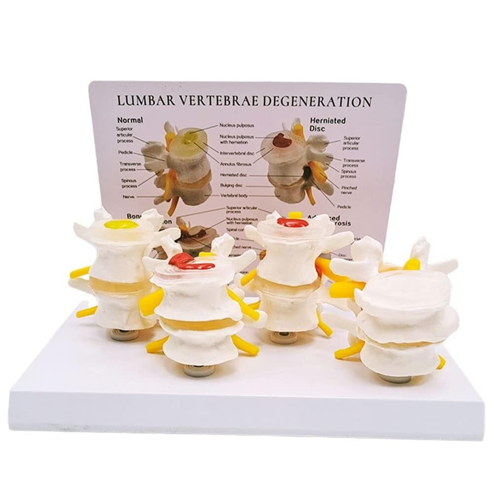 Human Skeleton Intervertebral Disc Herniation Model, 4 Stages of Lumbar ...