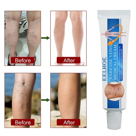 Legs Veins Ointment 20g Varicose Cream Varicose Veins Cream Phlebitis ...