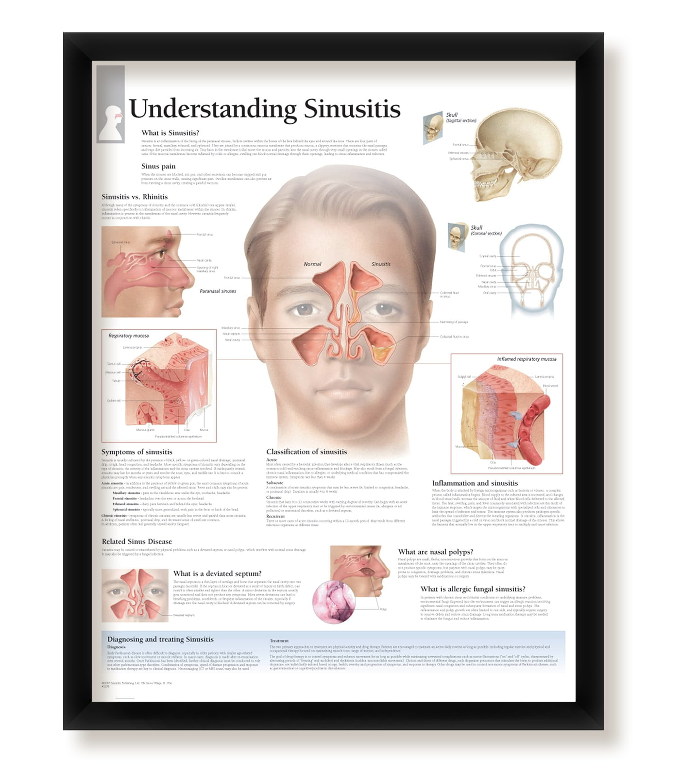 Understanding Sinusitis Framed Medical Educational Informational Poster ...