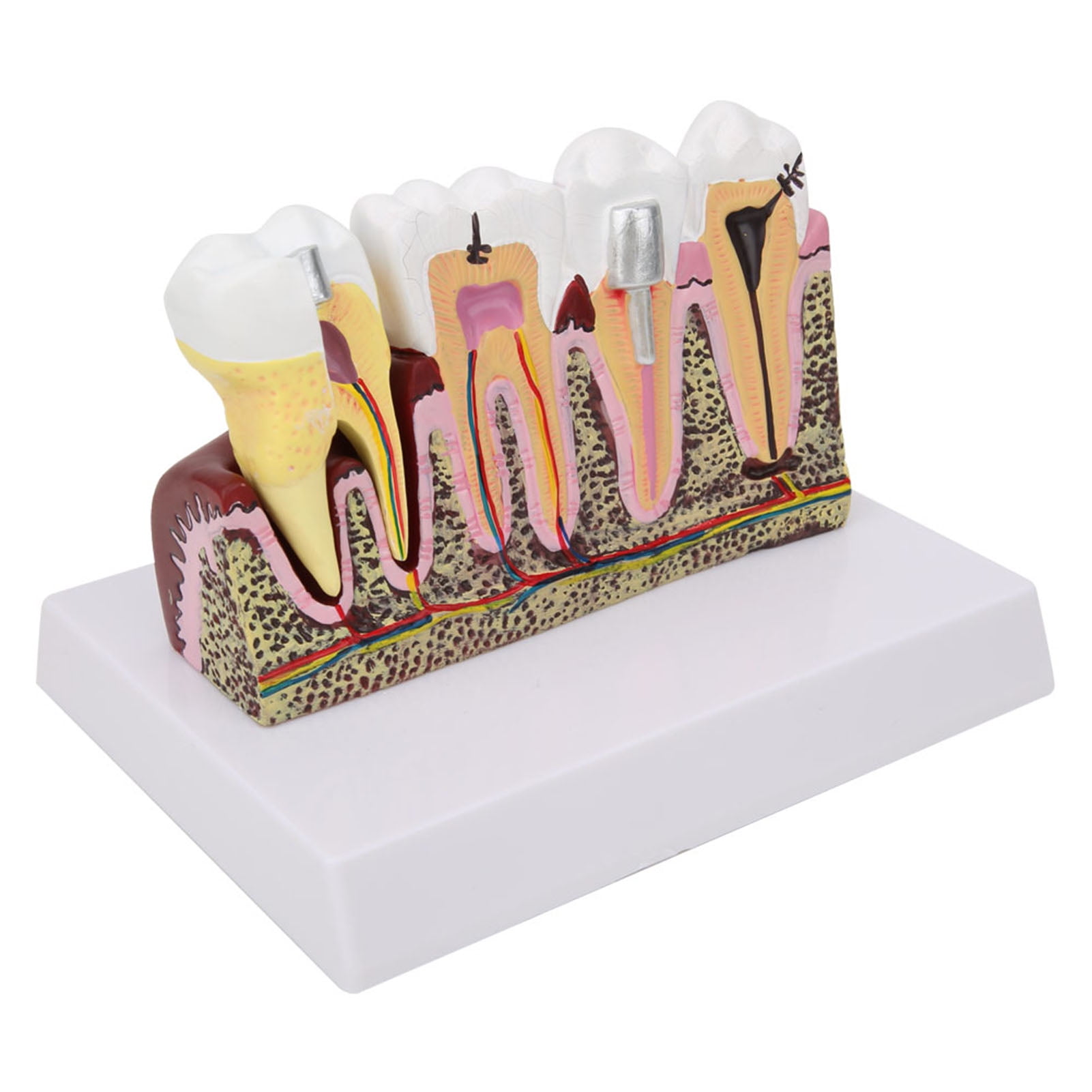 Modelo anatómico del diente, modelo de dientes dentales modelo dental ...