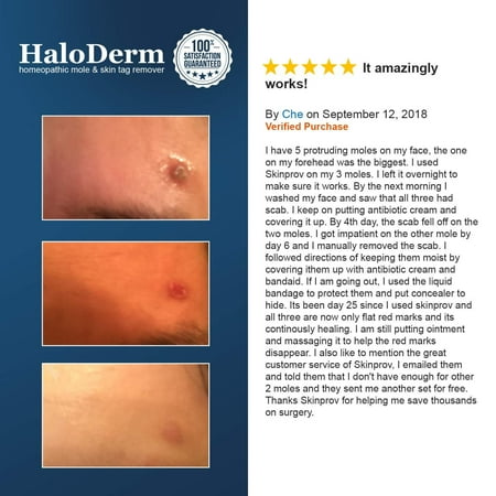 HaloDerm Skin Tag Remover & Mole Remover - All Natural Skin Tag Cream ...