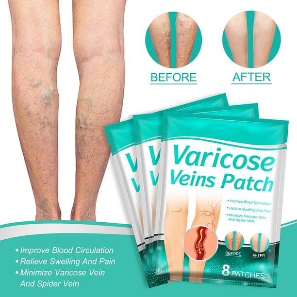 8 Pcs Varicose Veins Patch Vasculitis Phlebitis Spider Leg Stickers for ...