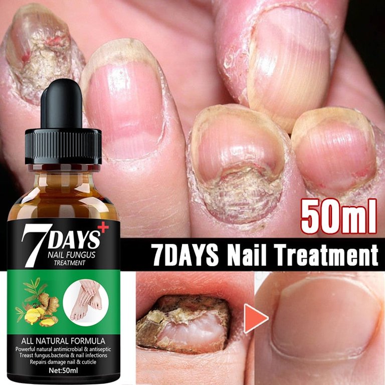 Hand Treatment For Nail Infection