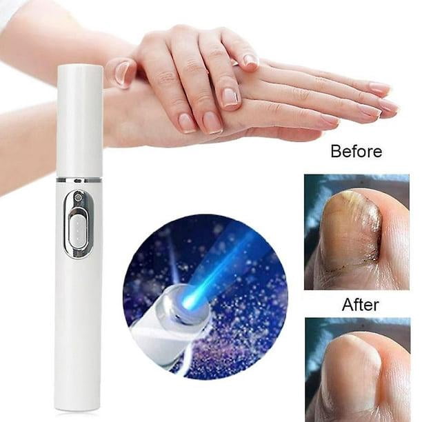 Nail Fungus Blue Light Laser Pointer, Painless Manicure For ...