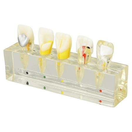 Oubit Dental Endodontic Model,Dental Pulp Cavity Model Dental Pulp ...