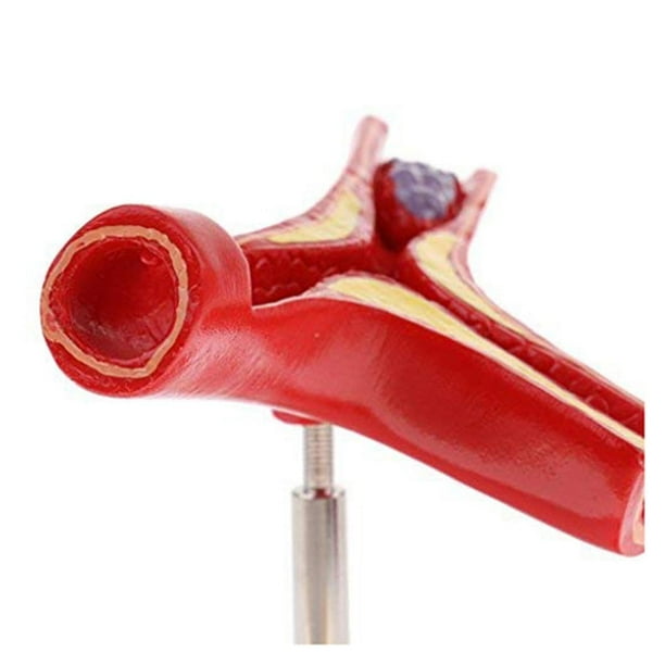 Human Atherosclerosis Cardiovascular Model Vascular Anatomy Model ...