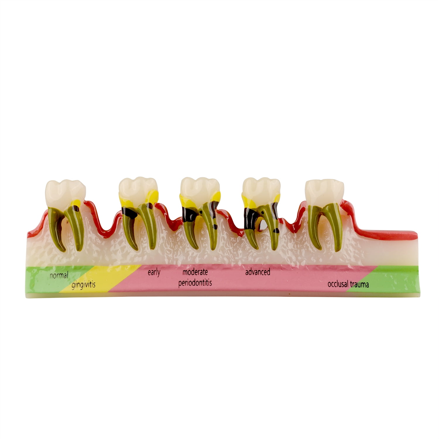 Dental Periodontal Disease Model, Dental Teeth Model for Dental Tooth ...