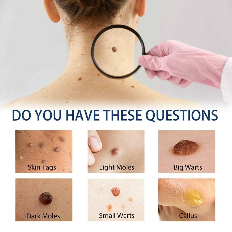 How To Get Rid Of Warts On Neck
