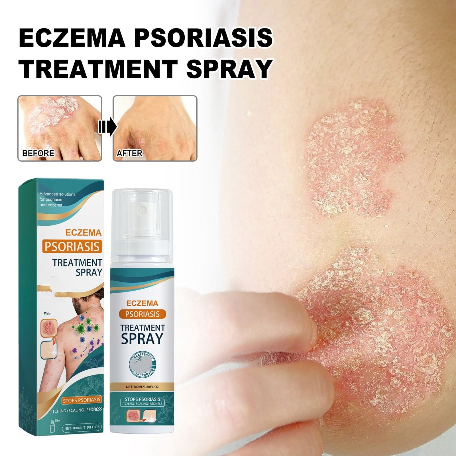 & Spray Maximum Strength Non Greasy Rapid Acting Formula For Itchy Dry ...