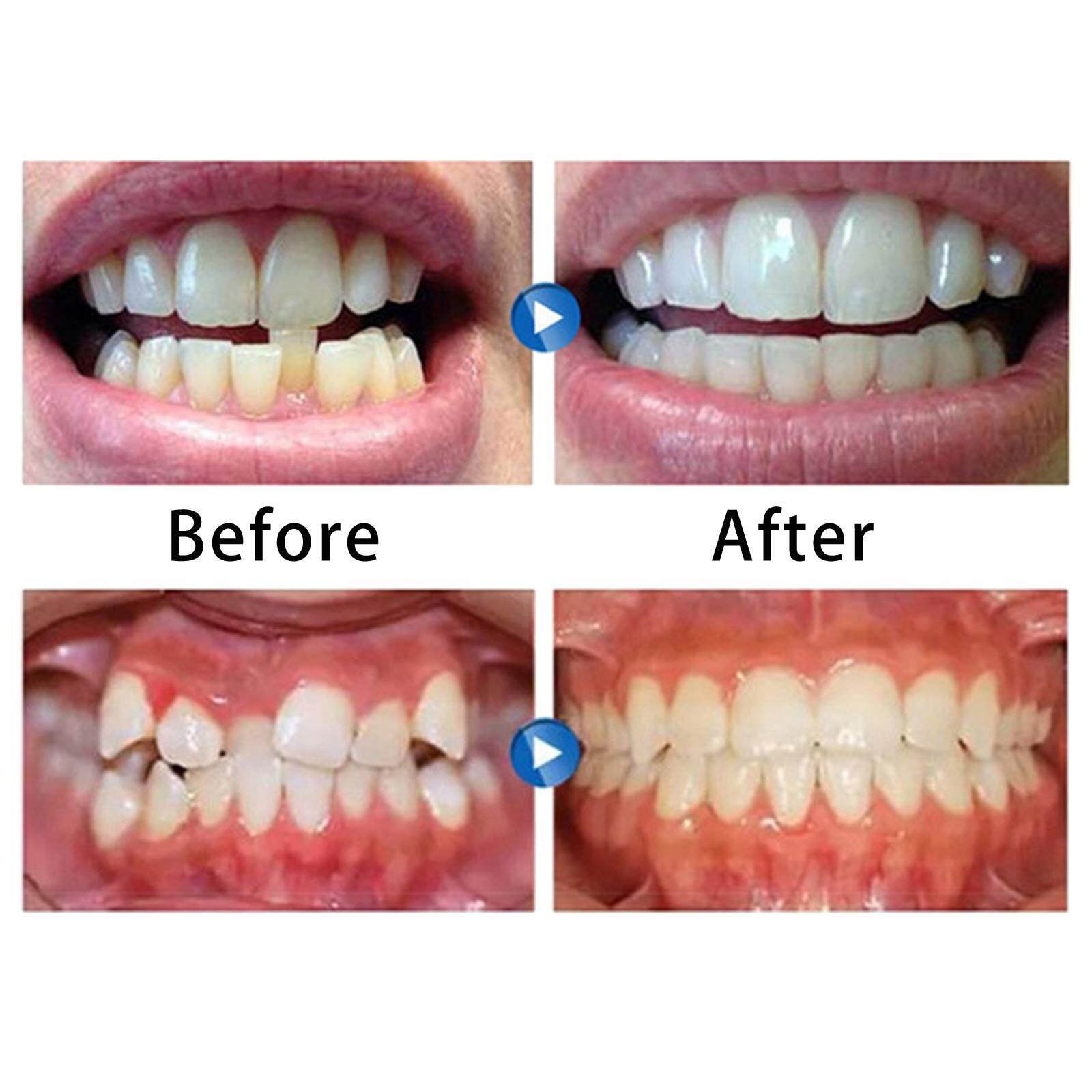 Click here for Mmirethe 3-In-1 Teeth Retainer Tooth Aligners Bion... prices