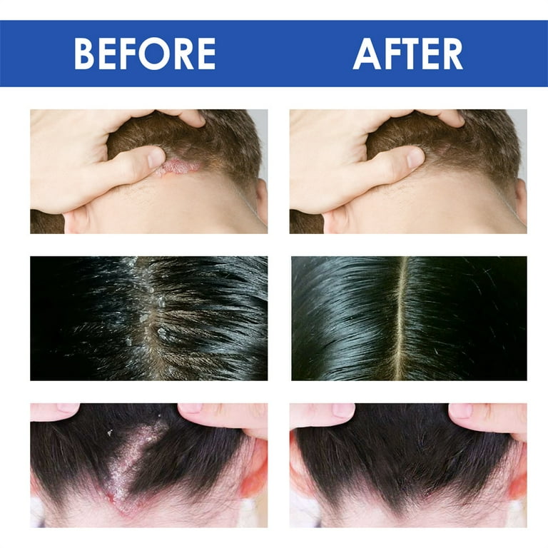 Eczema Scalp Treatment