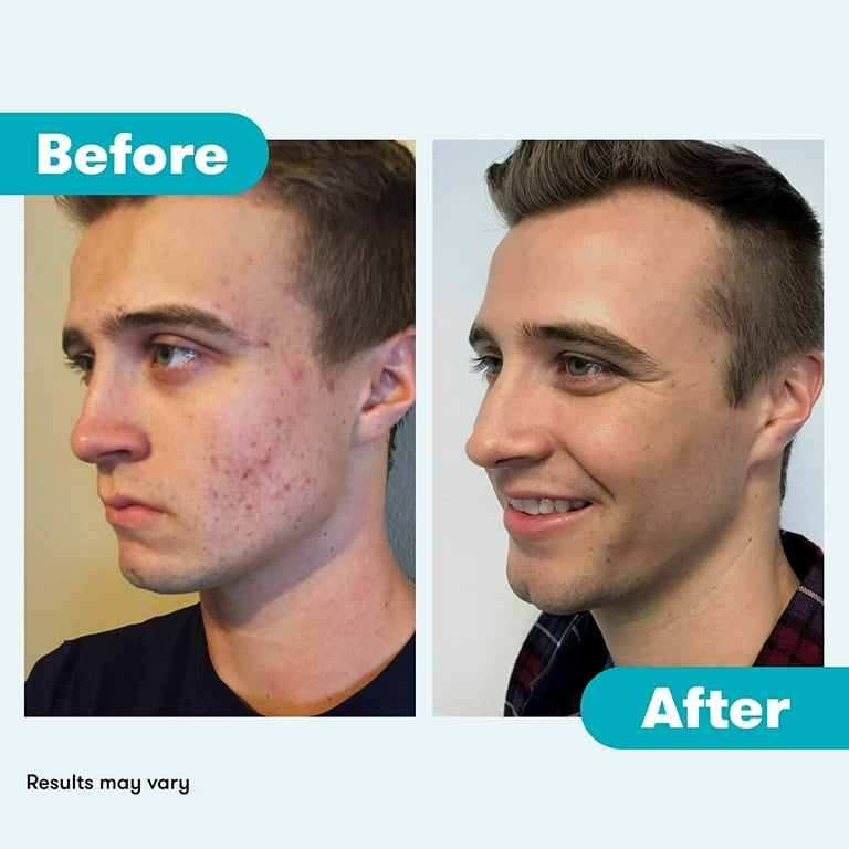 Acne Before And After Proactiv