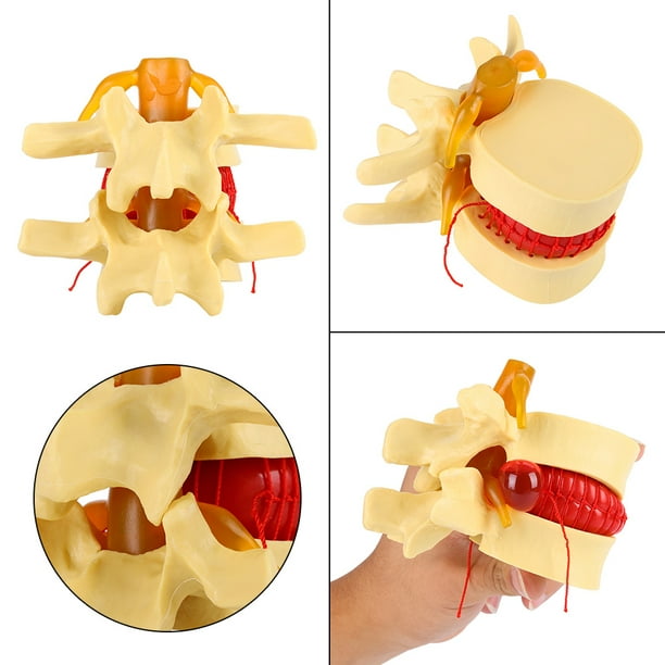 Modelo Lumbar Humano 1:1.5 Hernia De Disco Anatómica De La Columna ...