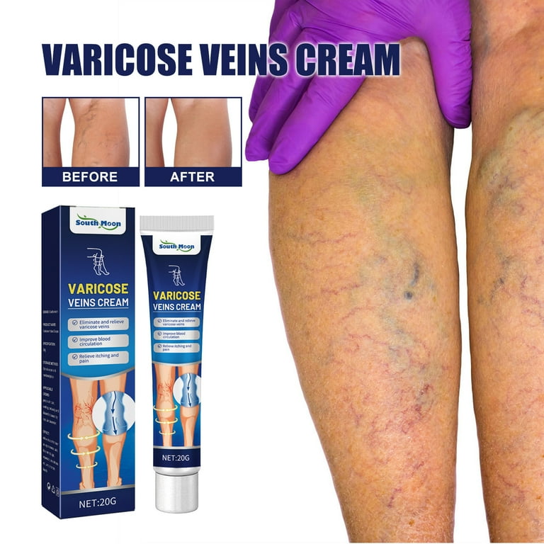 Varicose Vein Makeup For Legs | Saubhaya Makeup