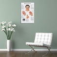 Anatomical Poster Rhinitis And Sinusitis Posters Wall Art Picture ...