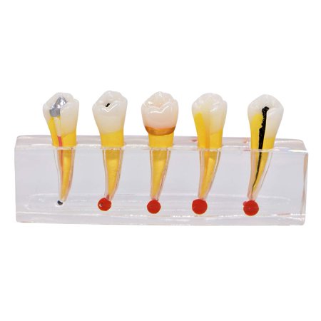 Dental Dental Pulp Restoration Pathological Model with Detachable Teeth ...