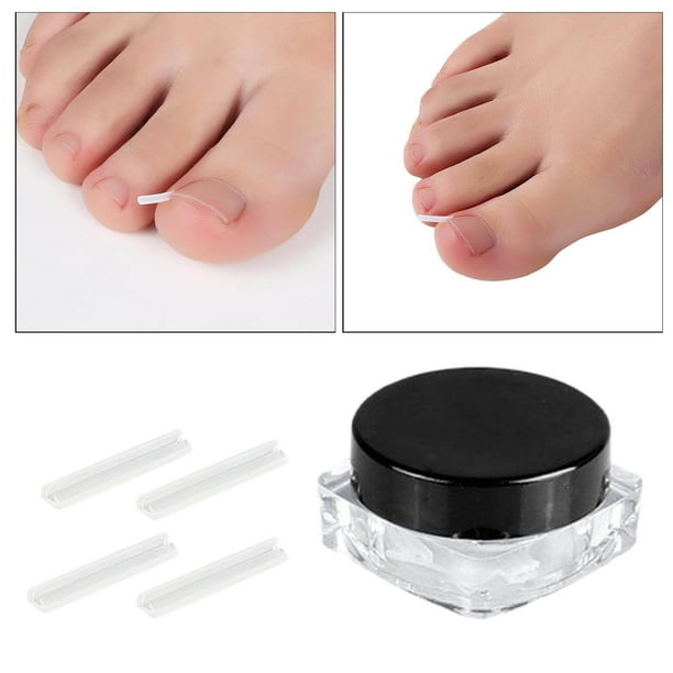 pitrice Ingrown Toenail Correction Tool Foot Toe Cleaner Tools Braces ...