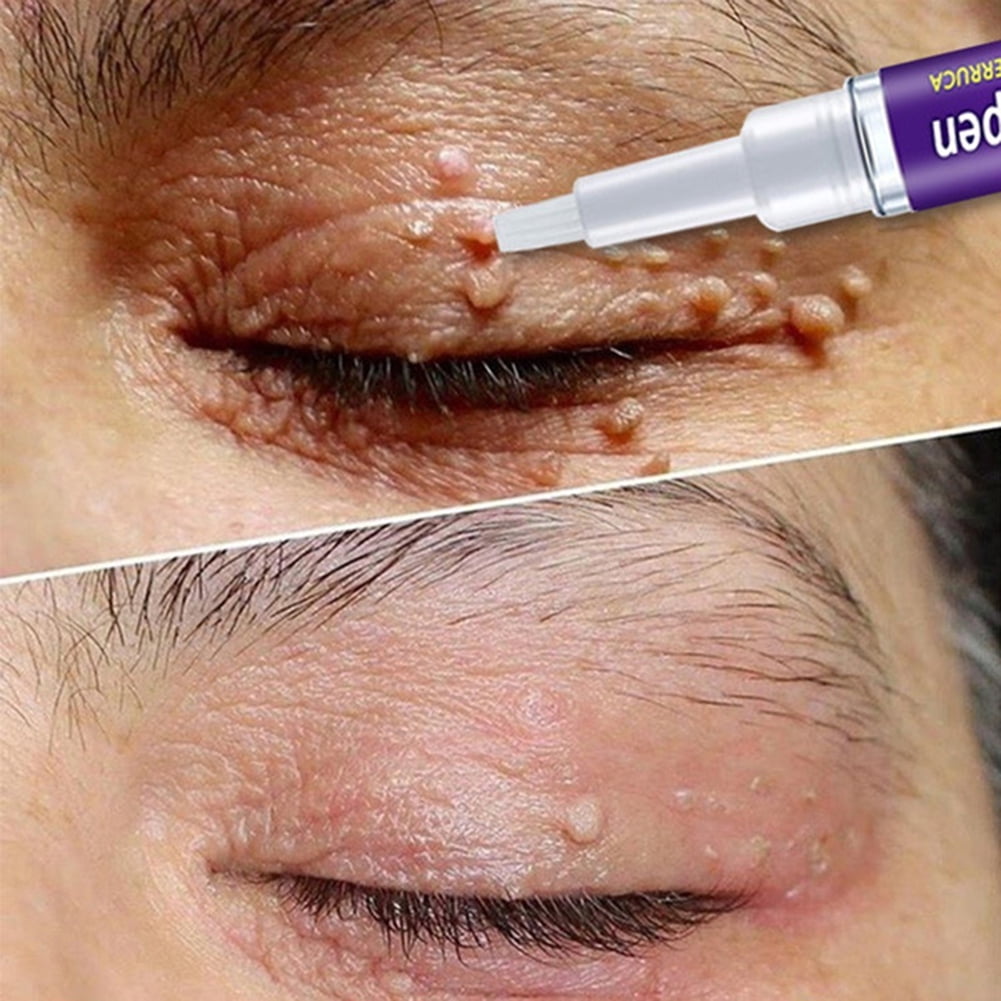 Crema de tratamiento corporal para eliminación de verrugas removedor de ...