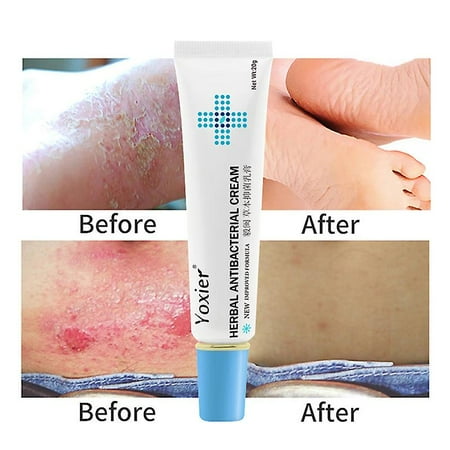 20g Skin Rash Cream Eczema Ointment Anti-fungal Cream Psoriasis ...