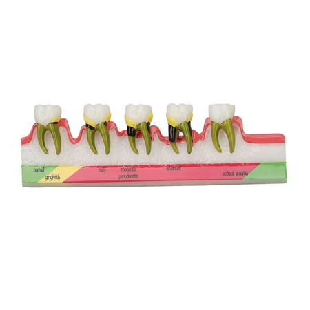 Periodontal Disease Display Model,Teeth Periodontal Disease Model ...