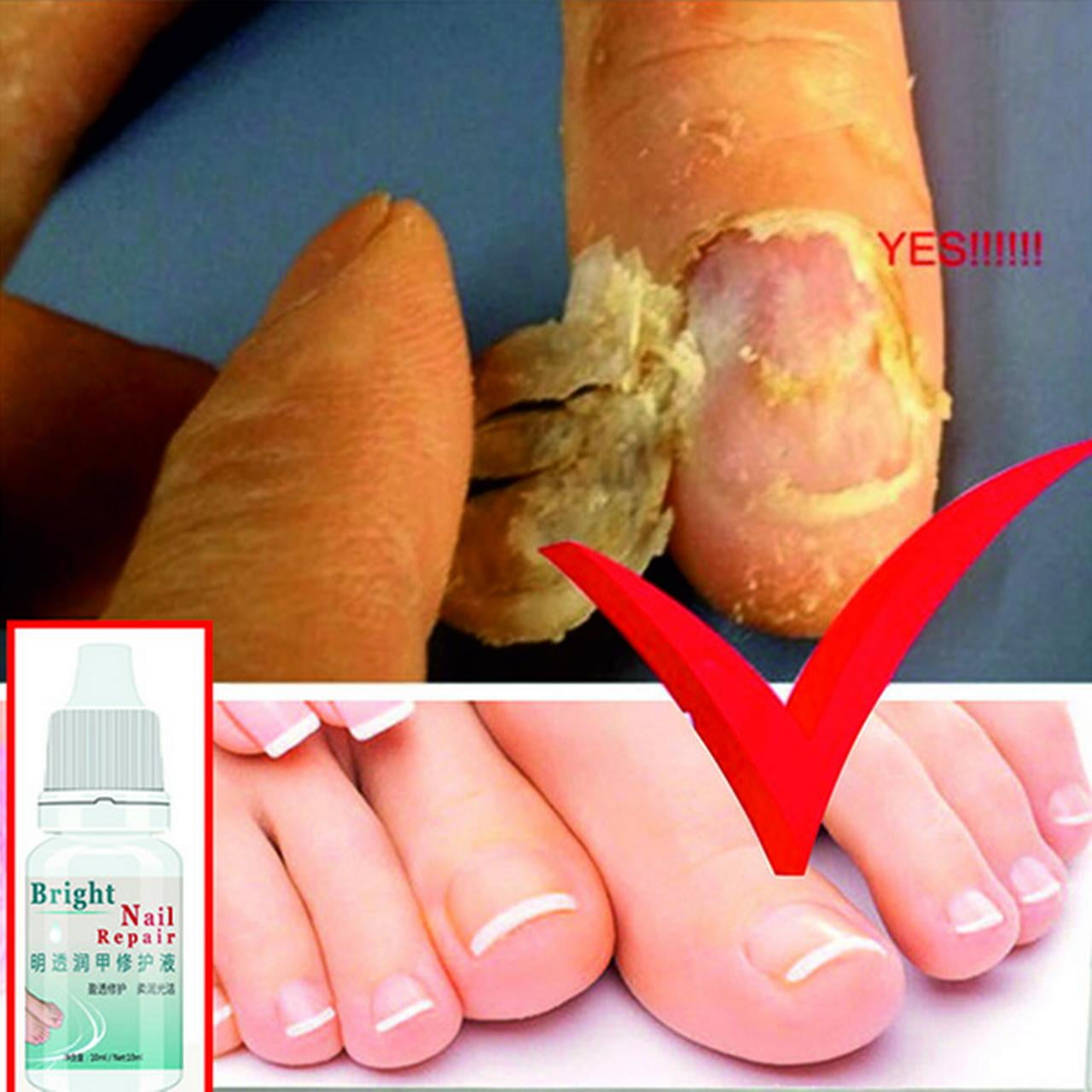 Buy 2Pcs Anti Fungal Treatment Extra Strength Toenail Fungus Athletes ...