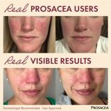 Prosacea Gel for Rosacea Redness, Pimples, and Irritation, Sulphur 1x ...