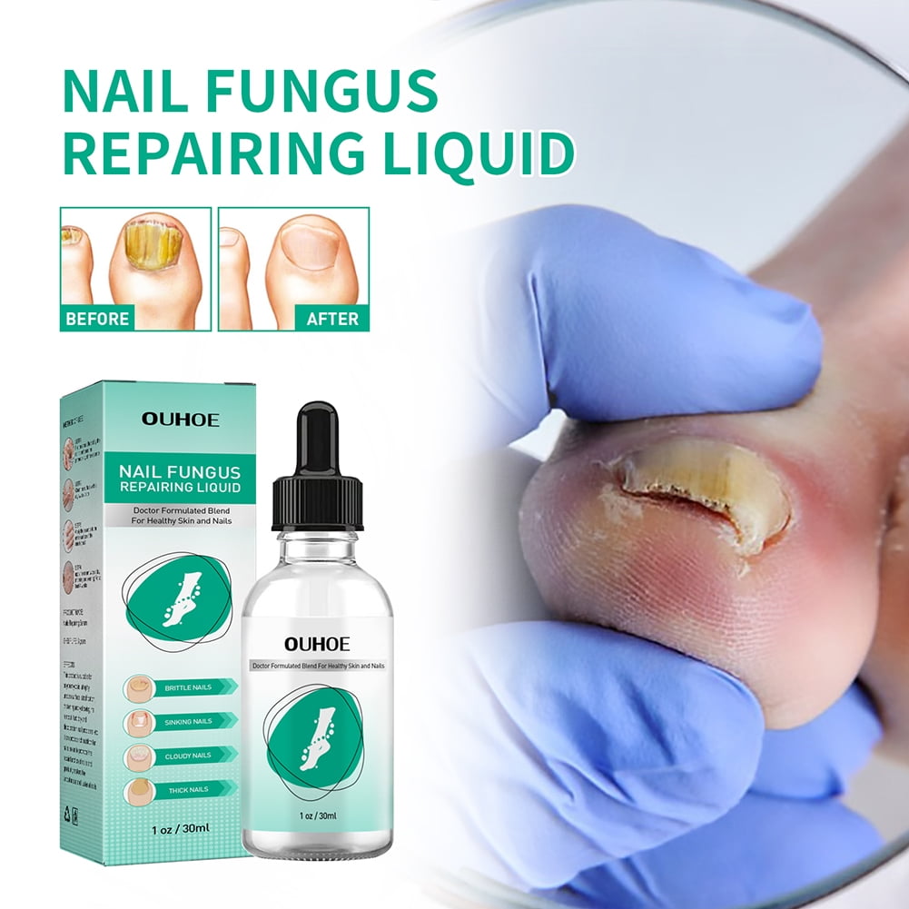 30ml Toenail Fungus Oil Nail Repair Liquid para uñas Anti Fungal ...