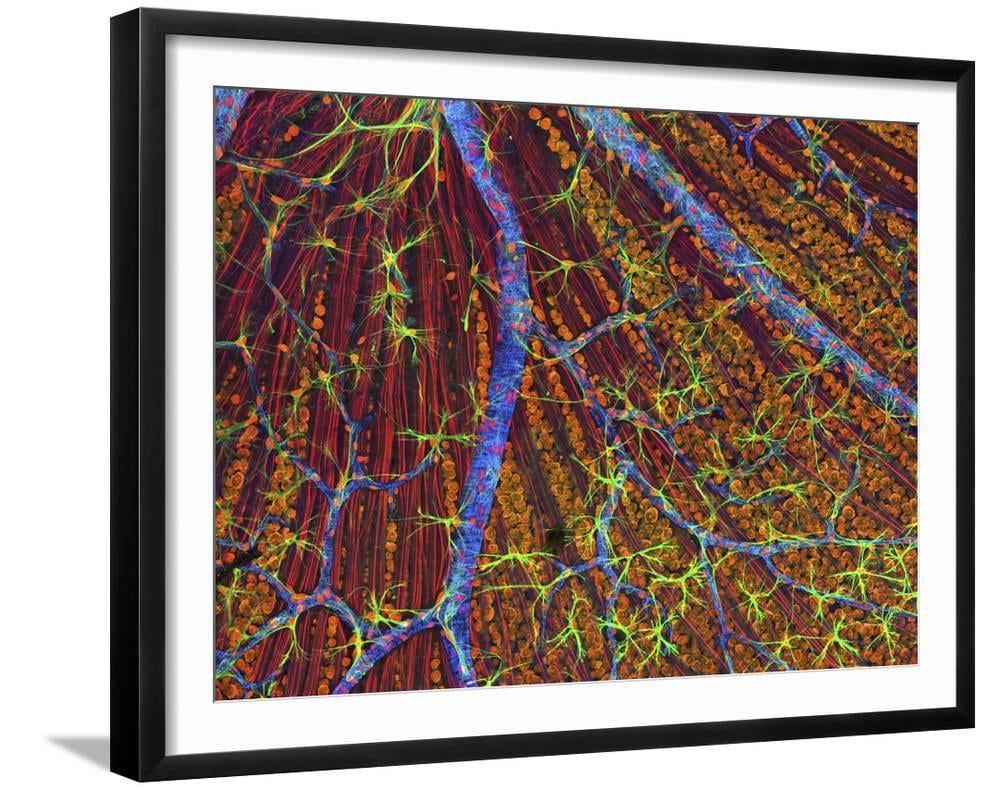 Neurofibromatosis, a Genetic Disorder of the Nervous System, Framed Art ...