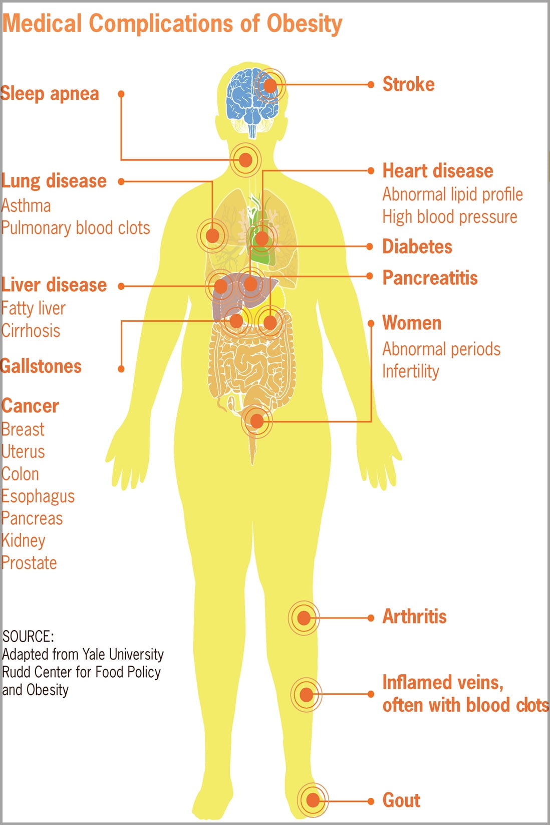 24x36 Gallery Poster Medical Complications Of Obesity And Being
