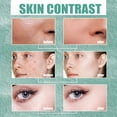 Cystic Hormonal And Severe Acne Cream For Teens And Adults Acne With