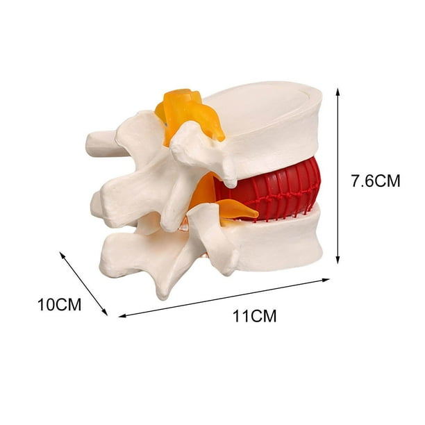 Lumbar Disc Herniation Model Lumbar Spine Model for skeleton Spine ...