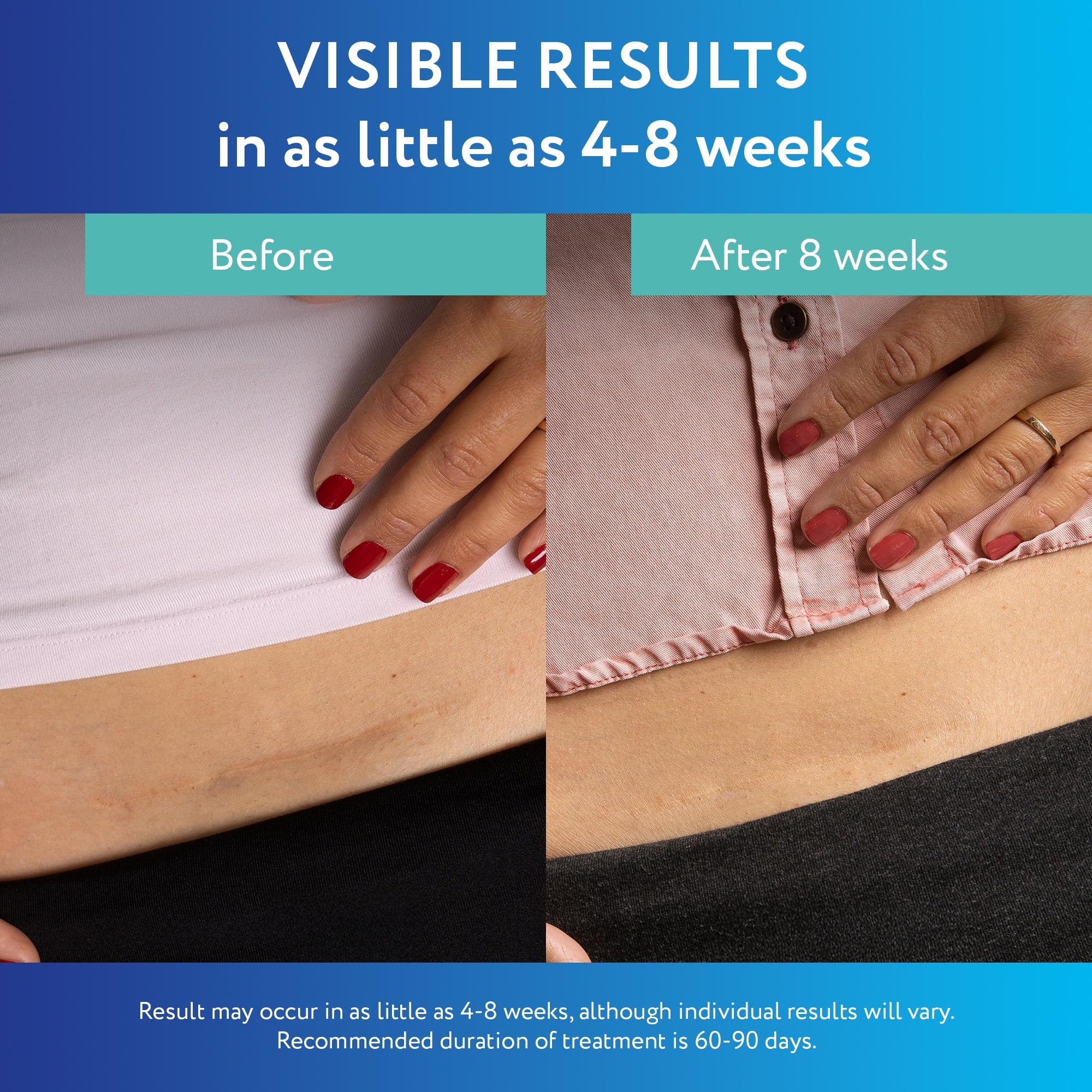 ScarAway Silicone Scar Sheets Shrink, Flatten and Nepal | Ubuy