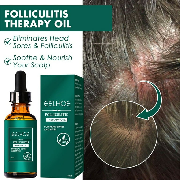 Sores On Scalp With Fluid