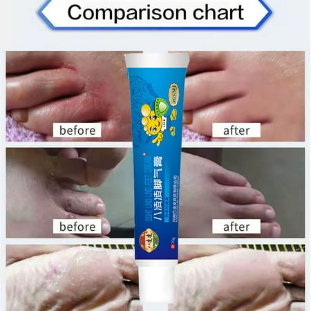 10pcs 20g Beriberi Treatment Anti Fungal Infections Foot Cream Anti-itch Athlete Relief Itch ...