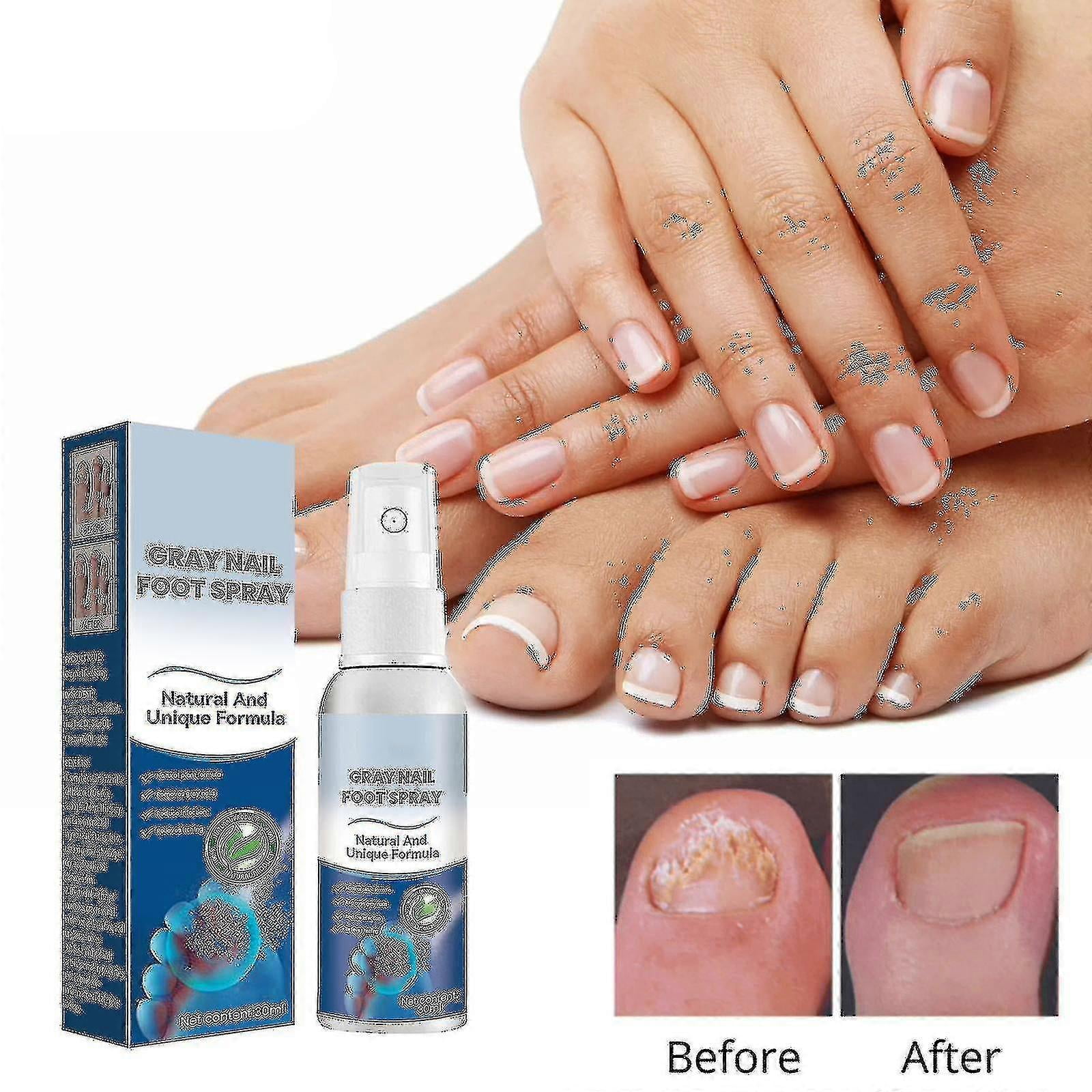 Click here for Rsmidremer Gray Nail Foot Spray  Nail Fungus Foot... prices
