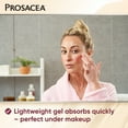 Prosacea Gel for Rosacea Redness, Pimples, and Irritation, Sulphur 1x ...