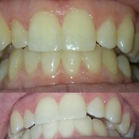 Crest Pro Health Advanced Mouthwash Staining - Crest Pro Health 33 8 Fl ...